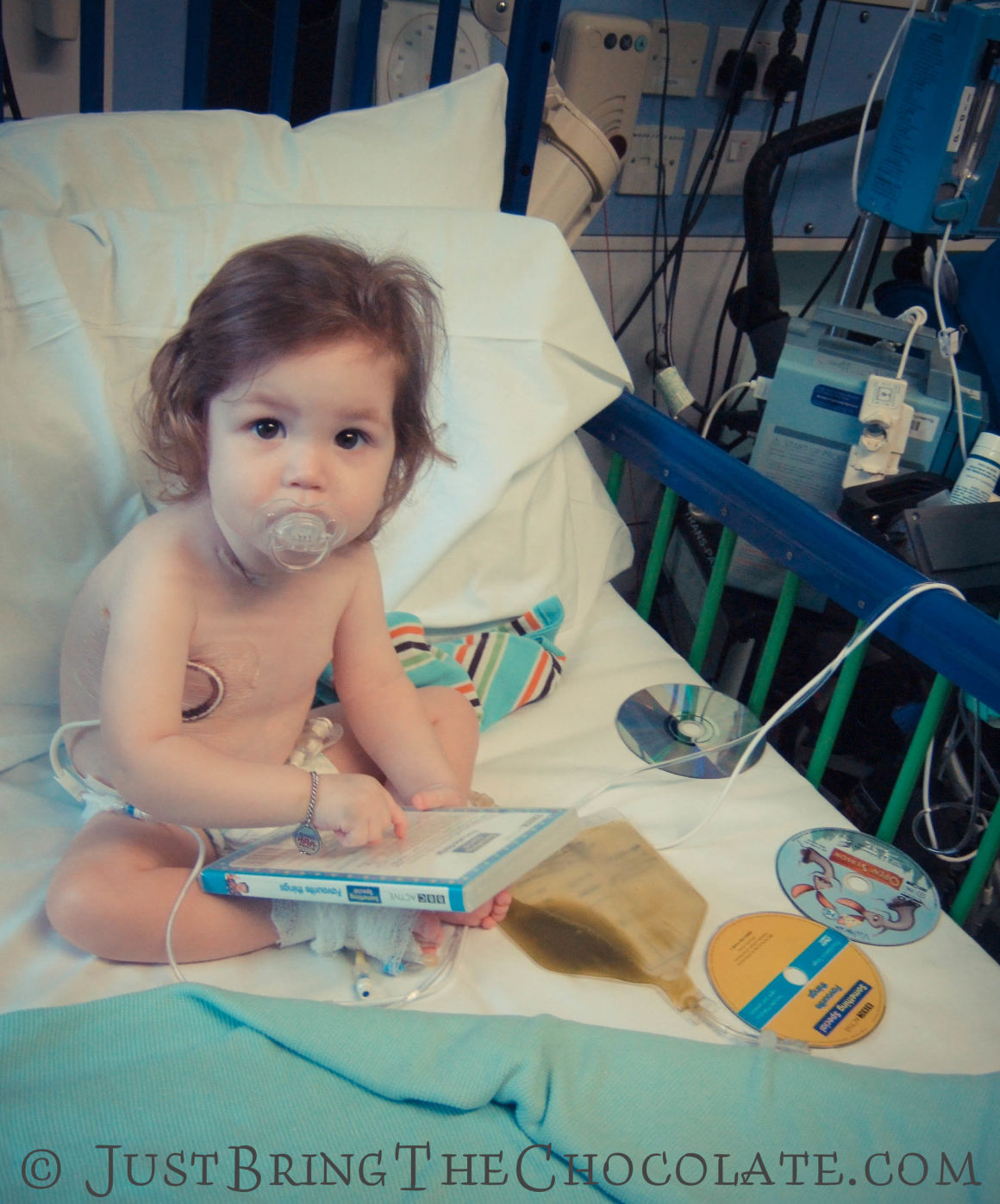 The gastrojejunal feeding tube (GJ tube)